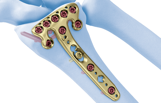 DePuy Synthes, Wright Medical Lead US Market for Orthopedic Small Bone ...