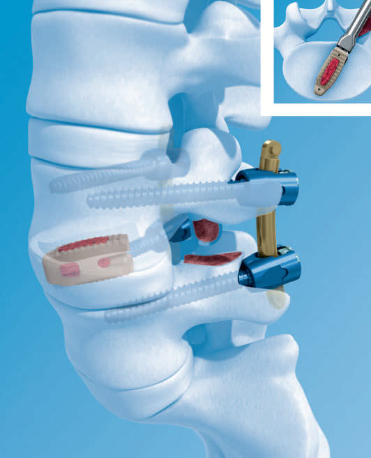 DePuy Synthes, Medtronic Leads Europe MIS Interbody Device Market ...