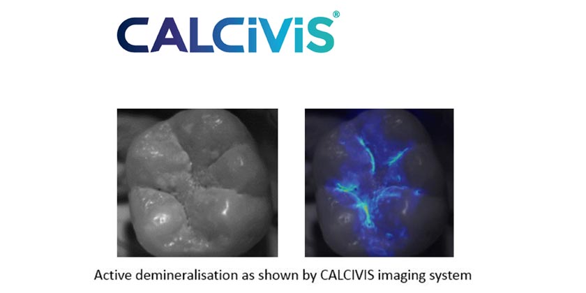 CALCIVIS Launches its Unique CALCIVIS Imaging System in the United ...
