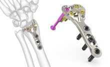 New ACTIS® Total Hip System from DePuy Synthes - iData Research