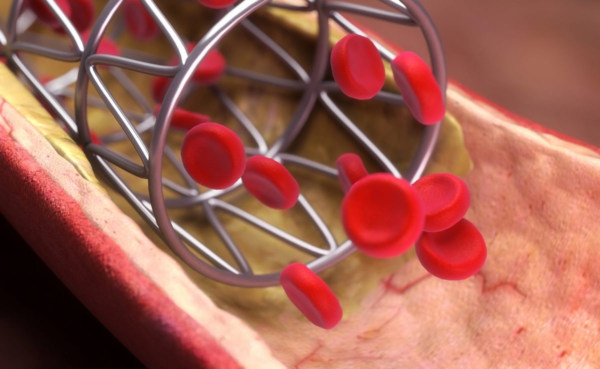 Best Coronary Stents from the Top Brands - iData Research